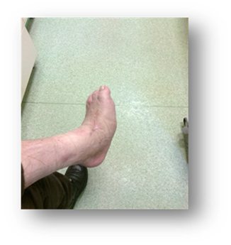 Co to jest zespół stopy cukrzycowej i jakie są jego postacie w ...